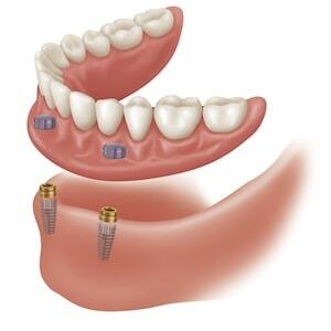 Single Stage Implant Therapy - Ph-03 | NQ Surgical Dentistry Townsville